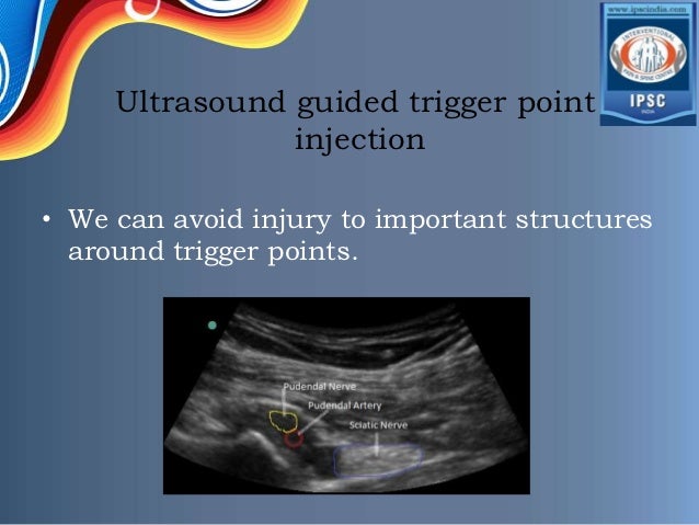 Trigger point injection