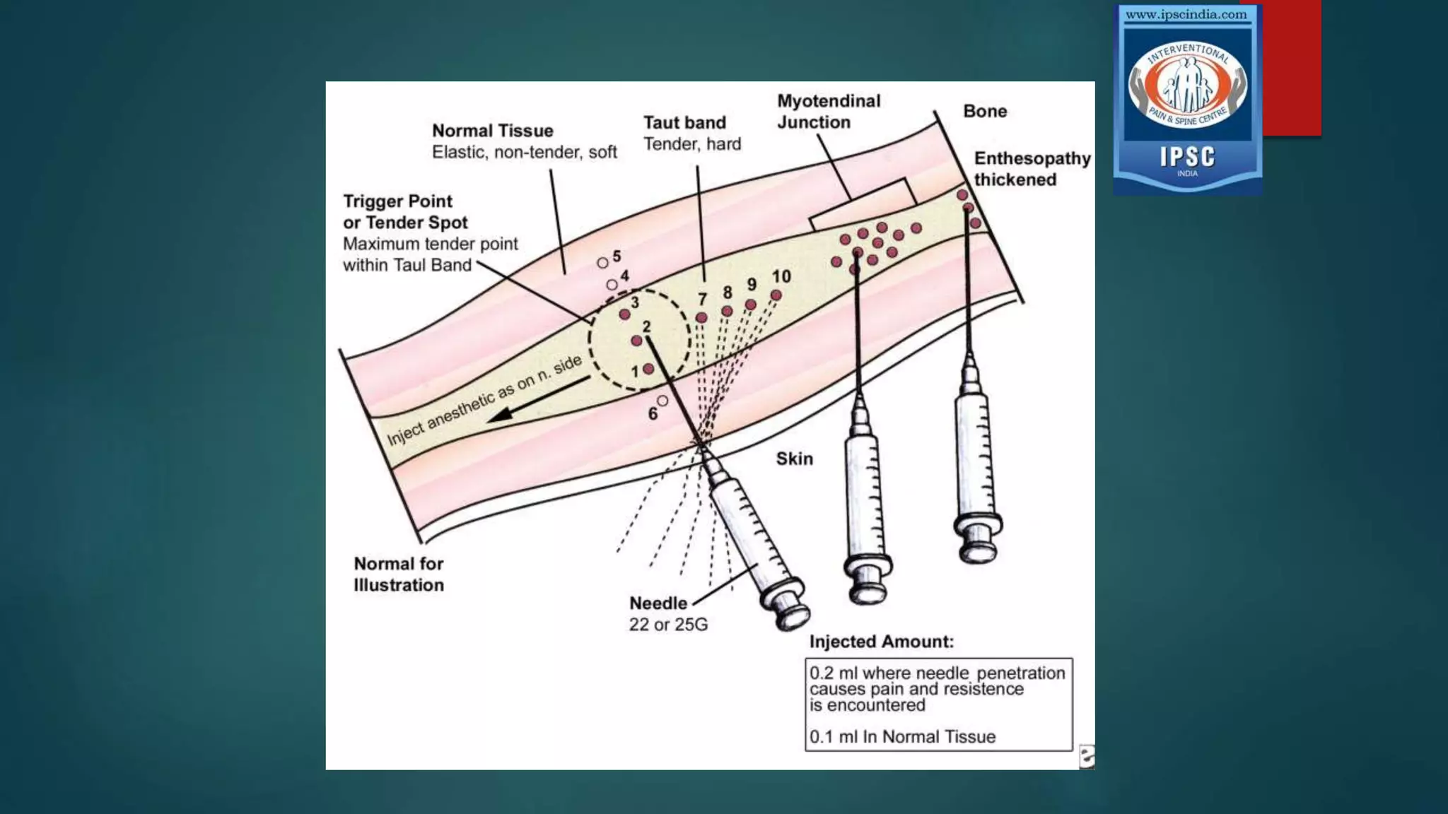 TRIGGER POINT INJECTION (TPI) MHD.pptx