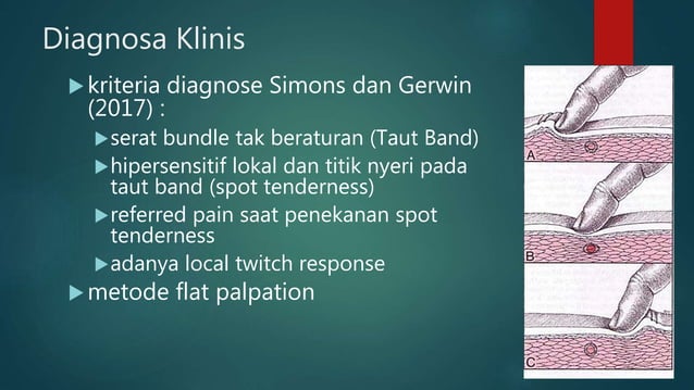 TRIGGER POINT INJECTION (TPI) MHD.pptx