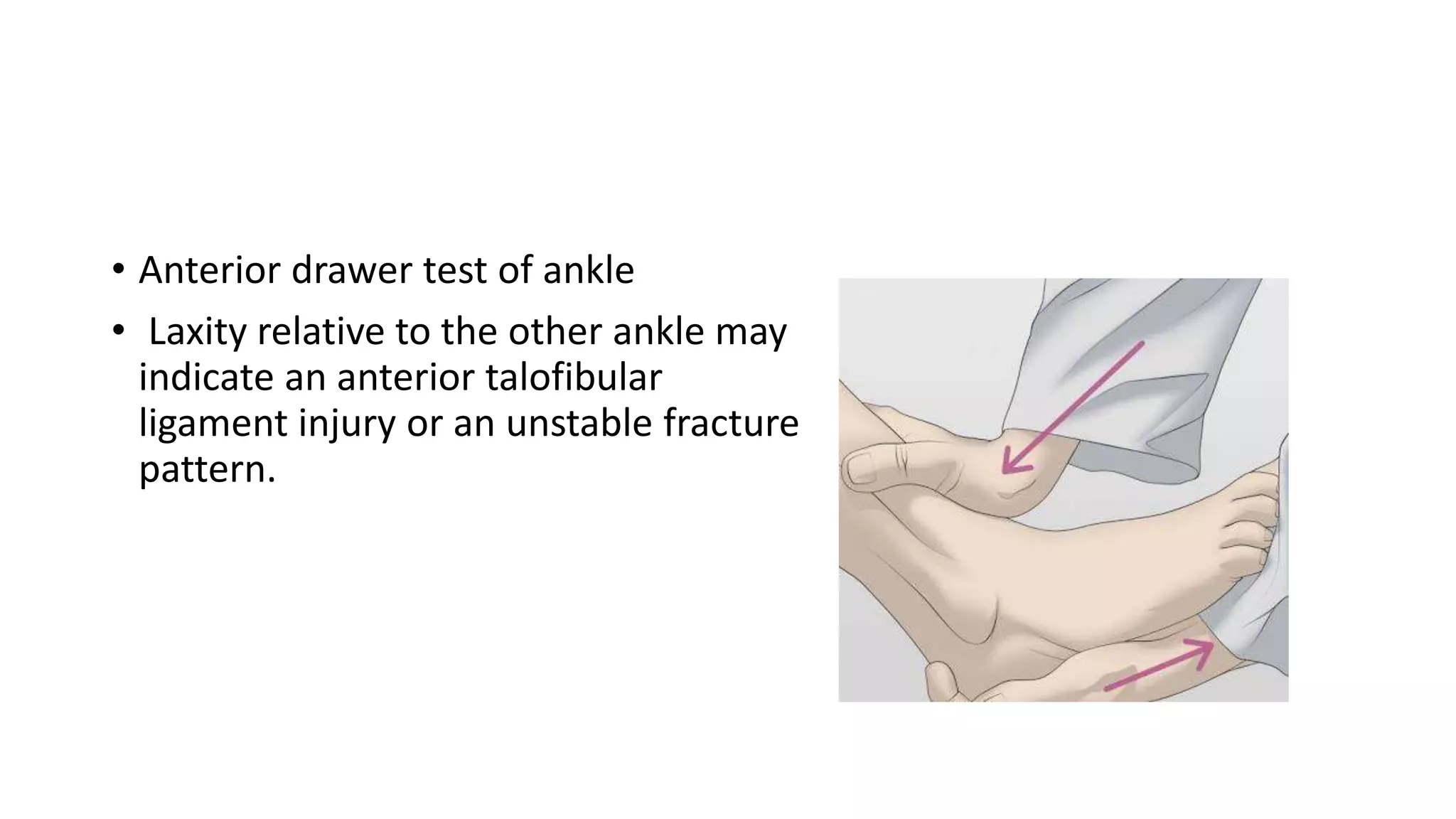 Ankle injuries & Trimallelor fracture classification | PPTX