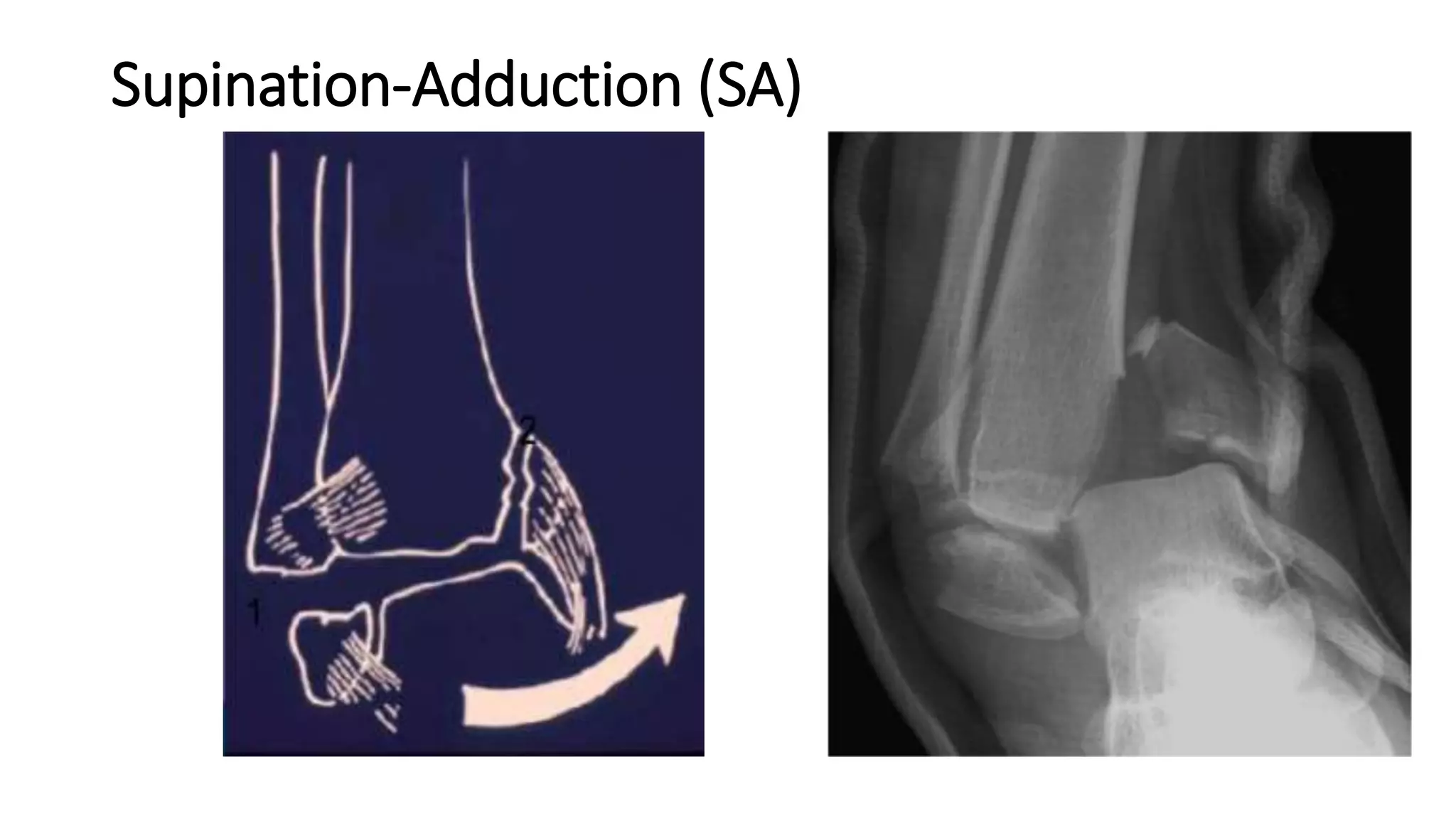 Ankle injuries & Trimallelor fracture classification | PPTX