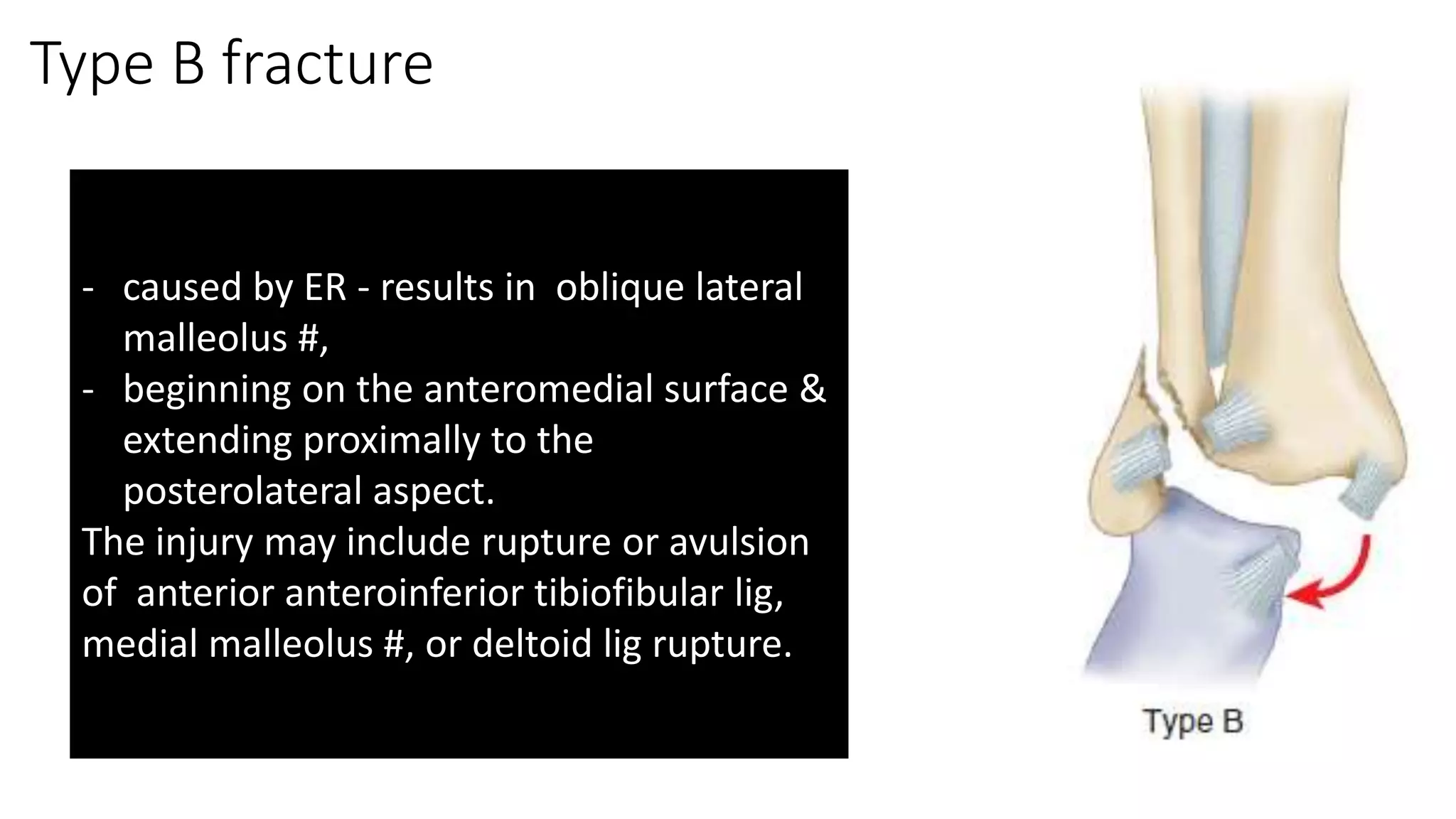 Ankle injuries & Trimallelor fracture classification | PPTX