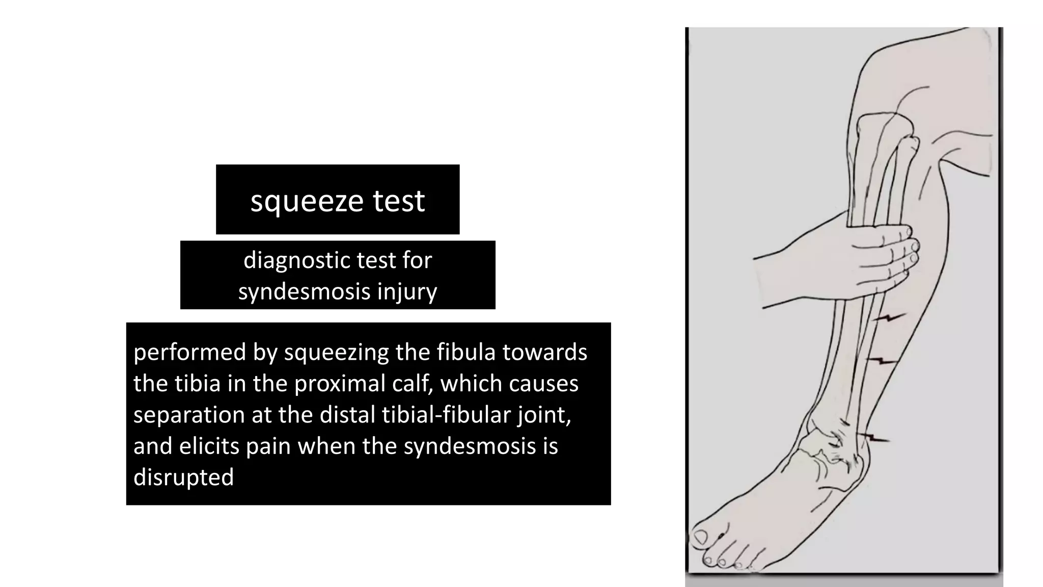 Ankle injuries & Trimallelor fracture classification | PPTX