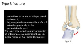 Trimalleolar Fracture Pain