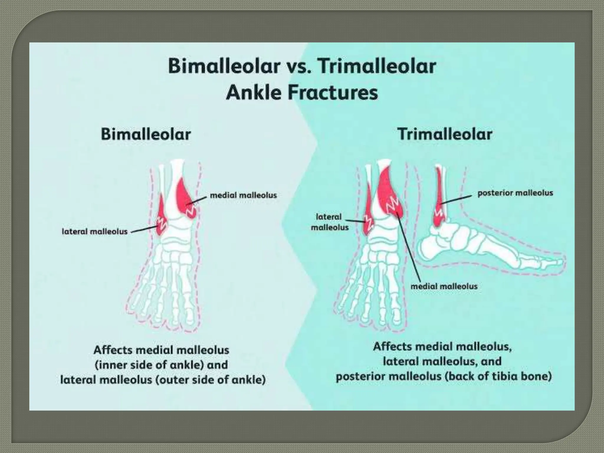 Trimalleolar Fracture.pptx. . | PPTX