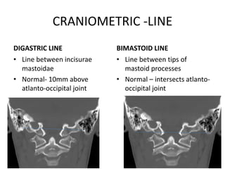 CRANIOVERTEBRAL JUNCTION | PPTX