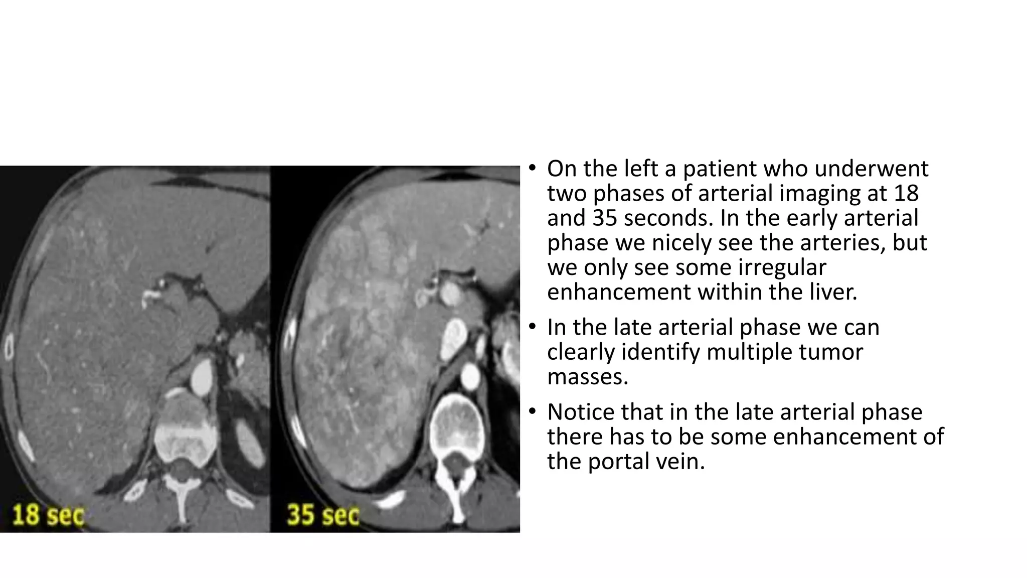 Triphasic CT scan | PPTX