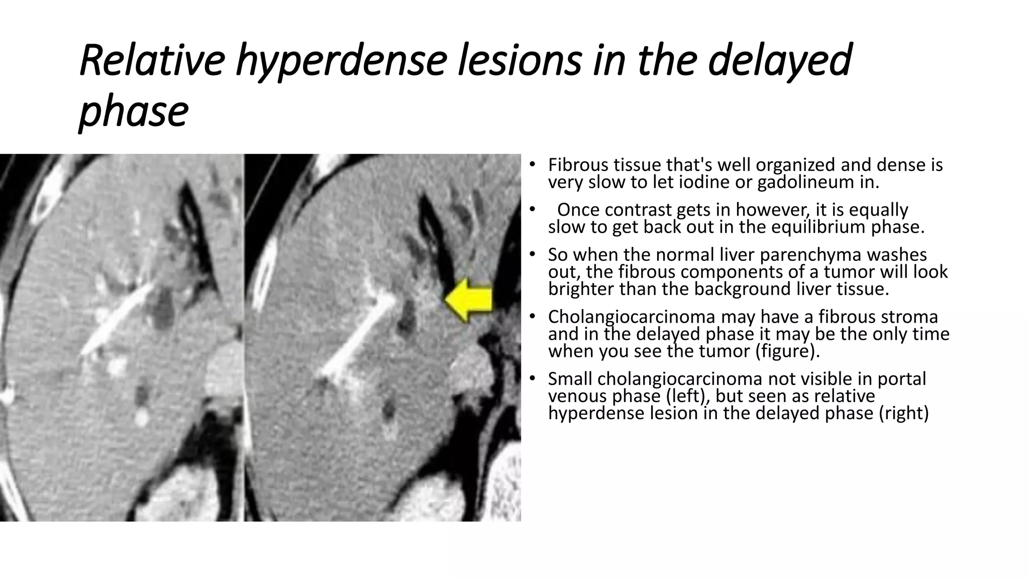 Triphasic CT scan | PPTX