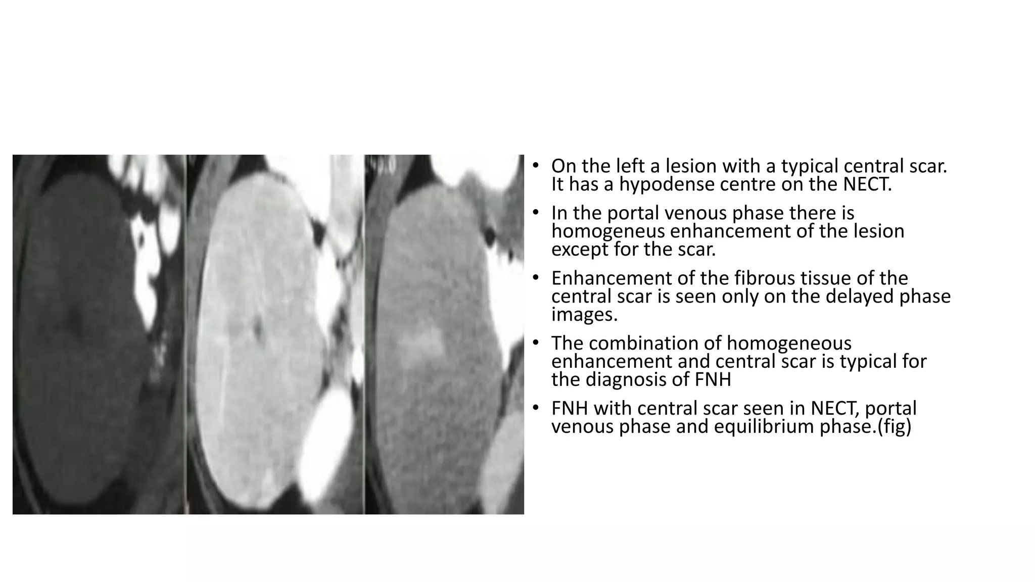 Triphasic CT scan | PPTX
