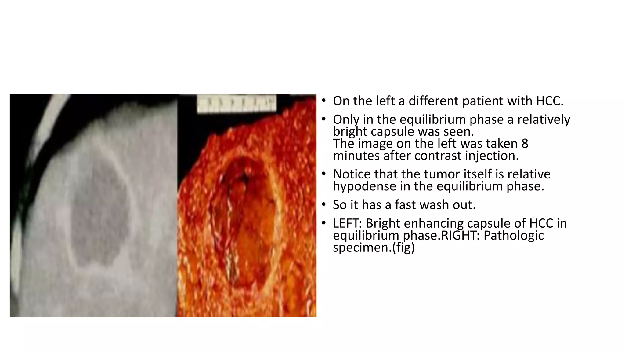 Triphasic CT scan | PPTX