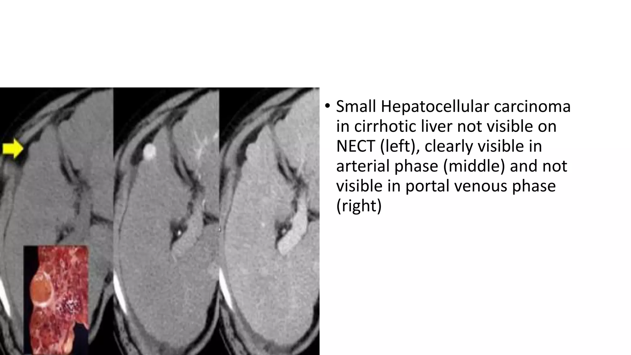 Triphasic CT scan | PPTX