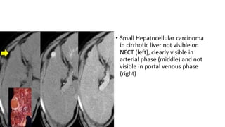 Triphasic CT scan | PPTX