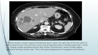 Triphasic CT Scan of Liver radiology.pptx