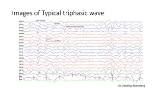 Triphasic waves in EEG | PPTX