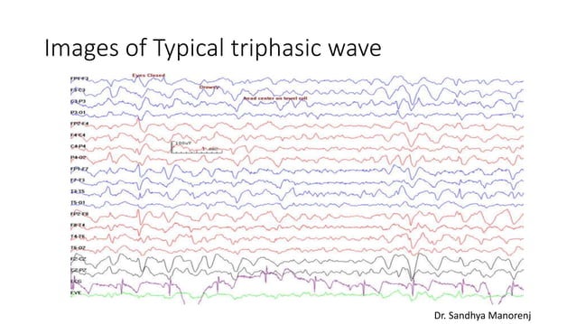 Triphasic waves in EEG
