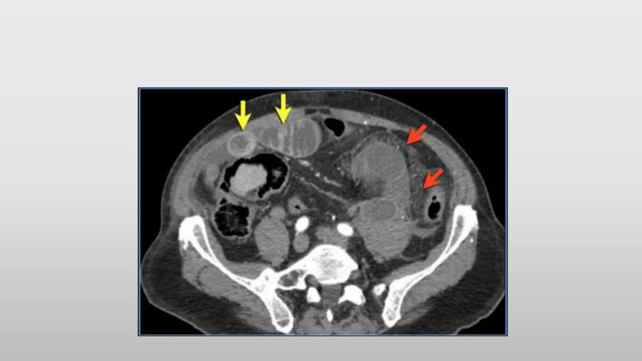 Triple phase ct PowerPoint slide PPT pk | PPTX
