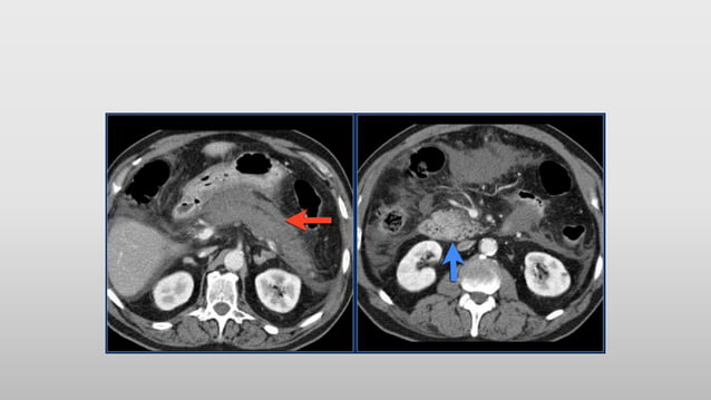 Triple phase ct PowerPoint slide PPT pk | PPTX
