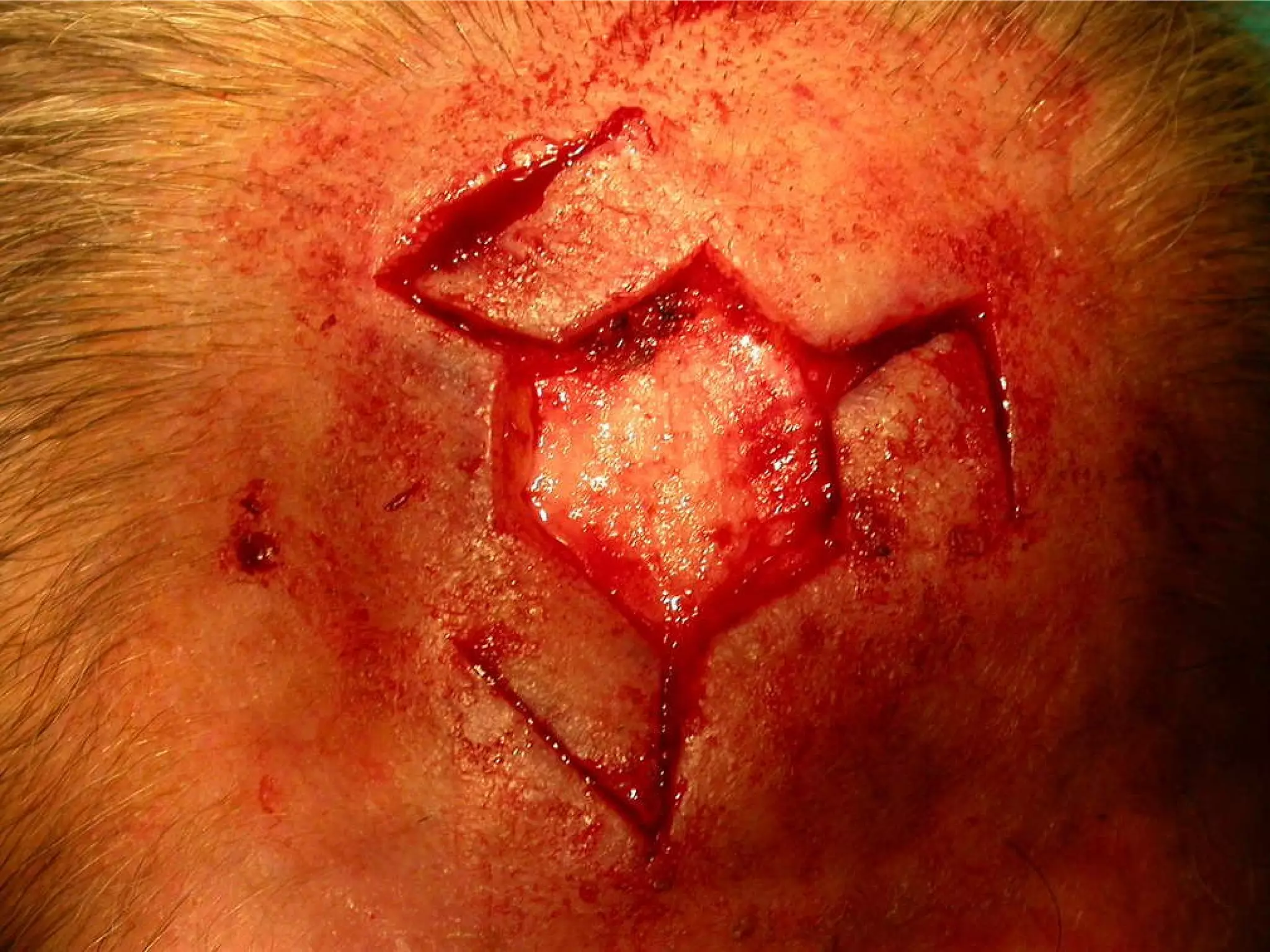 Triple Rhomboid Flap | PPT