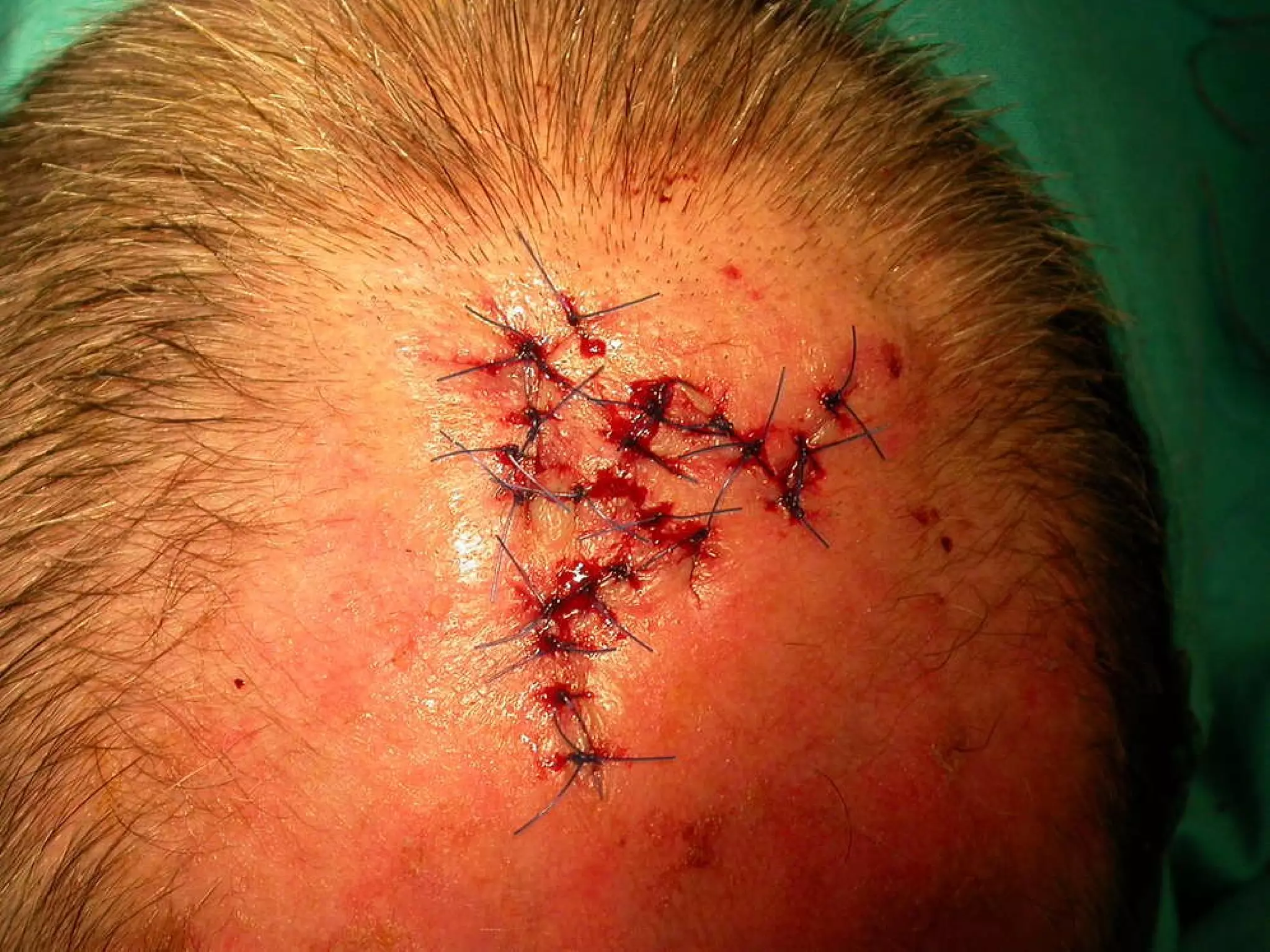 Triple Rhomboid Flap | PPT