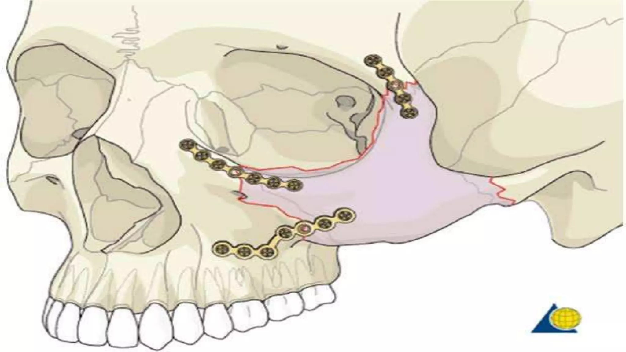 Tripod fracture | PPTX