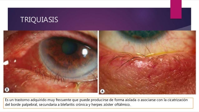 Triquiasis y distiquiasis