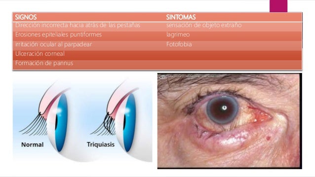 Triquiasis y distiquiasis