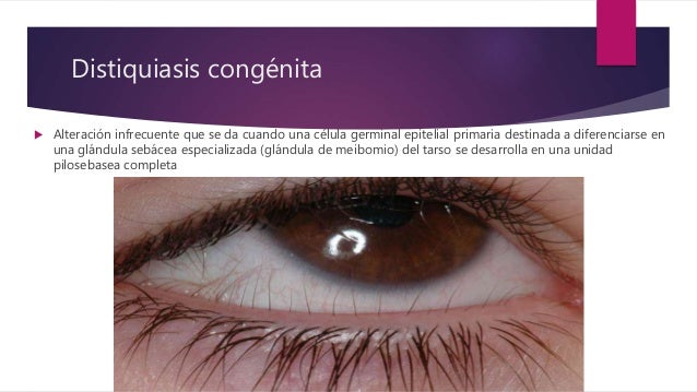 Triquiasis y distiquiasis