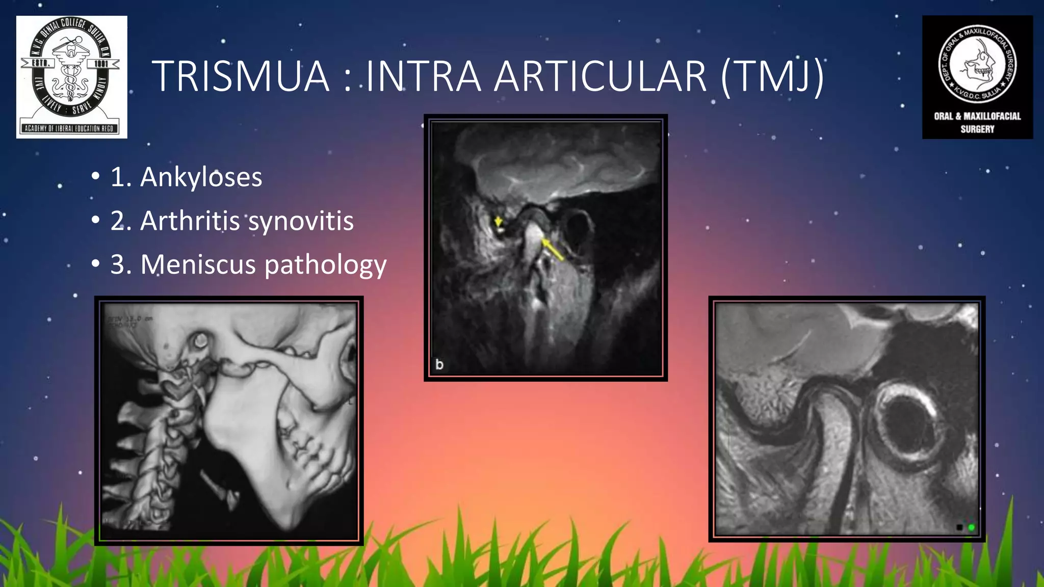 Differential Diagnosis of Trismus | PPTX