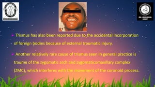 Differential Diagnosis of Trismus | PPTX