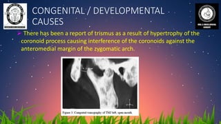 Differential Diagnosis of Trismus | PPTX
