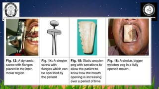 Differential Diagnosis of Trismus | PPTX