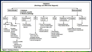 Differential Diagnosis of Trismus | PPT