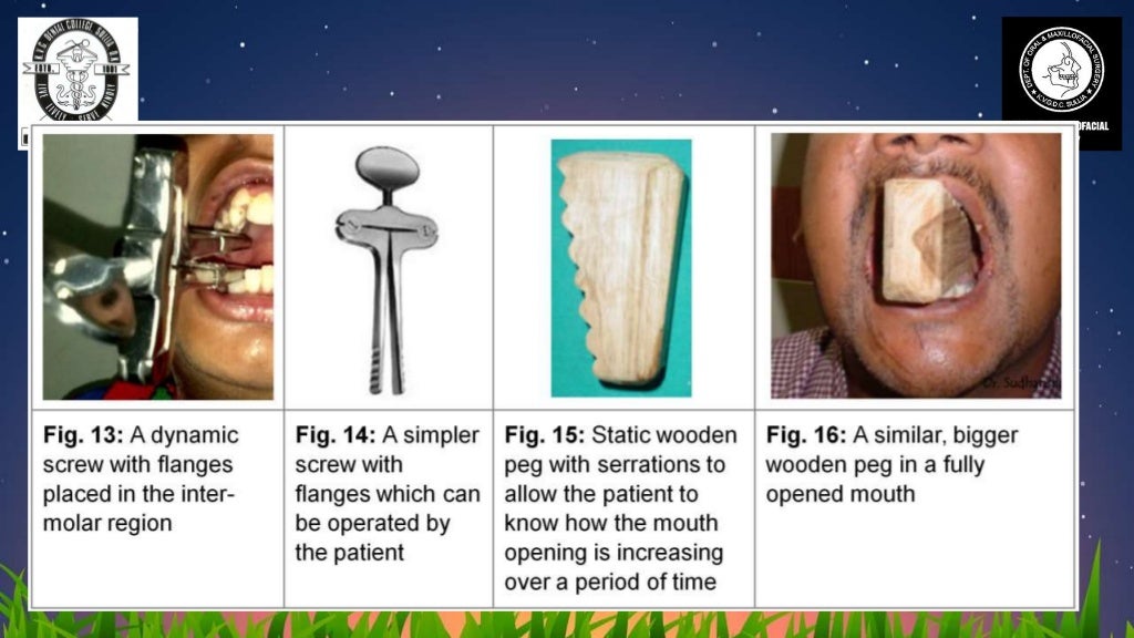 Differential Diagnosis of Trismus