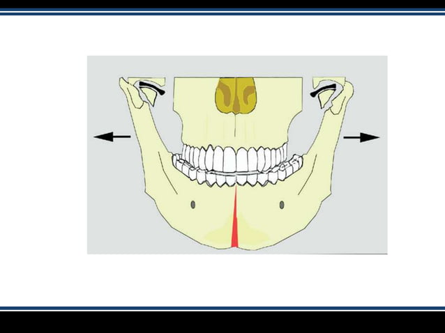 Trismus | PPTX | Dental Health | Diseases and Conditions