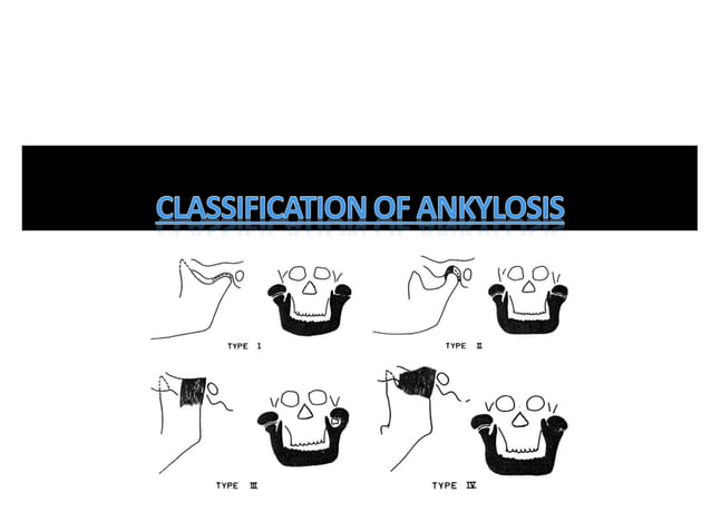 Trismus | PPTX | Dental Health | Diseases and Conditions