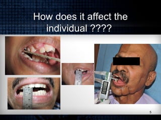 Trismus systematic review | PPT