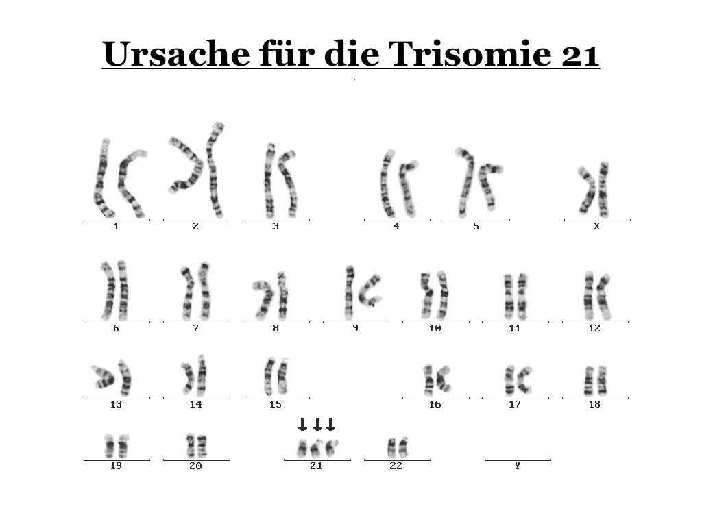 Translokations Trisomie 21 Bedeutung – WTQM