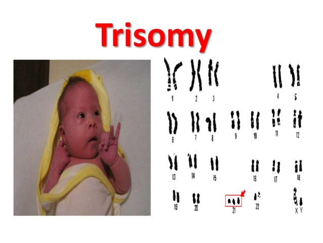 Trisomy 07-04-2015