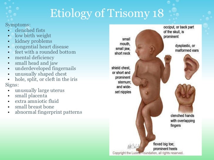 Trisomy 18 Types _ Trisomie 18 : cause, symptômes, conséquences, durée de vie – FFPKG