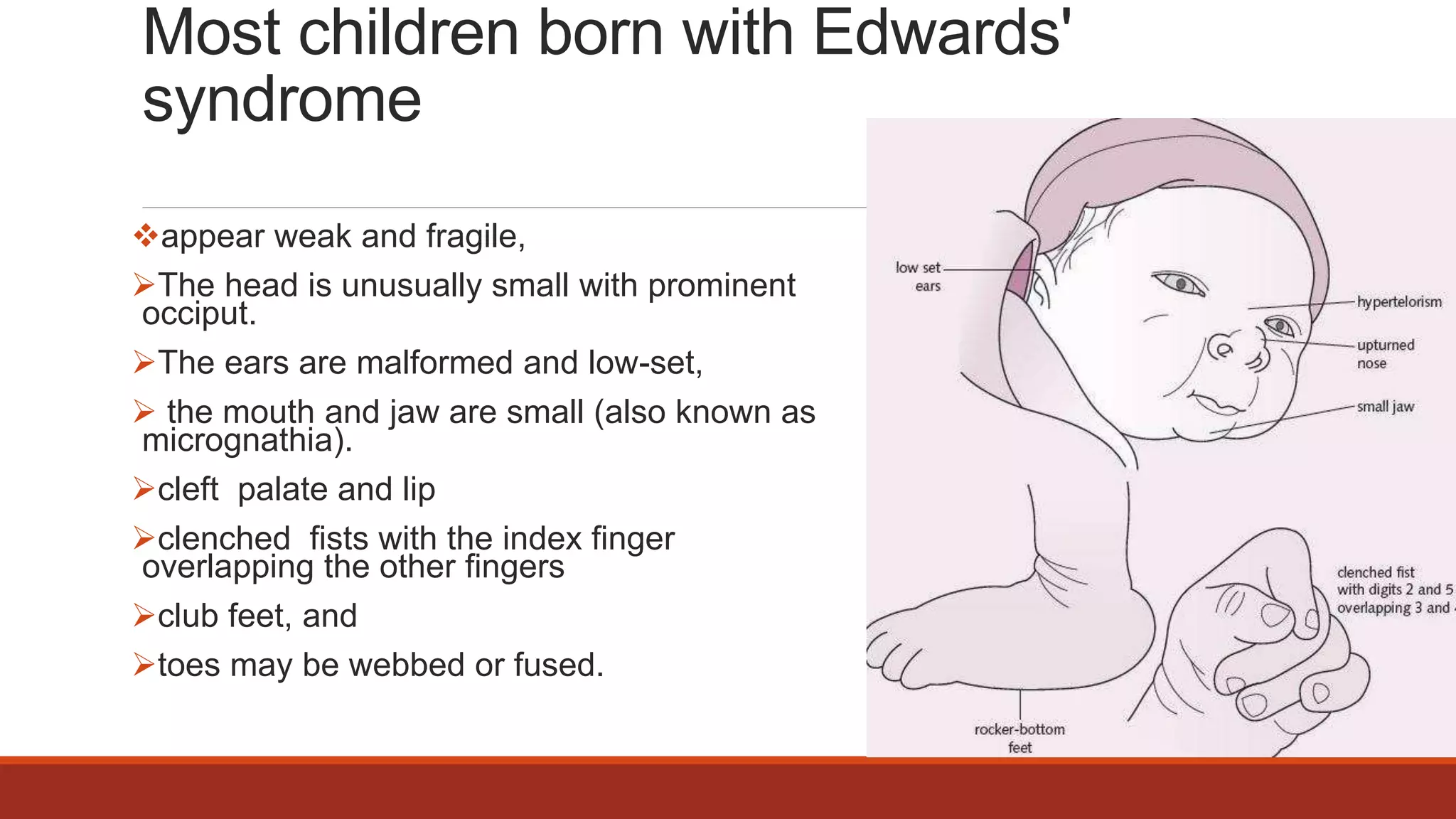 trisomy 18 and trisomy 13.pptx