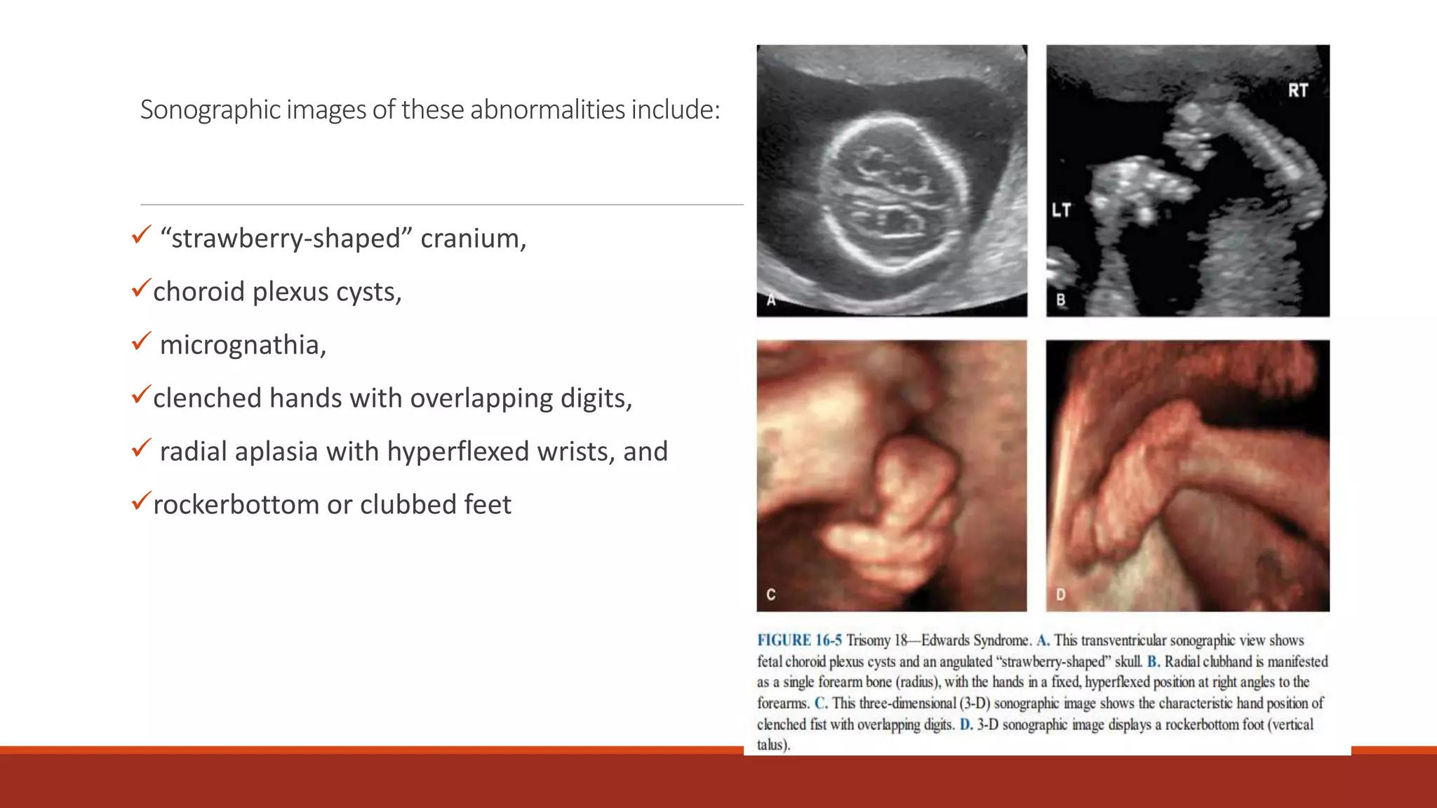 trisomy 18 and trisomy 13.pptx