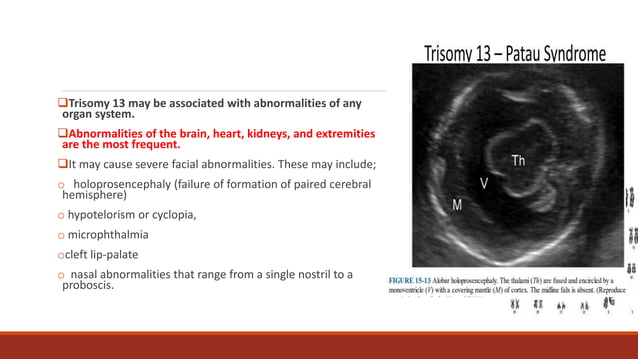 trisomy 18 and trisomy 13.pptx | Pregnancy | Reproductive Health