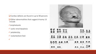 trisomy 18 and trisomy 13.pptx