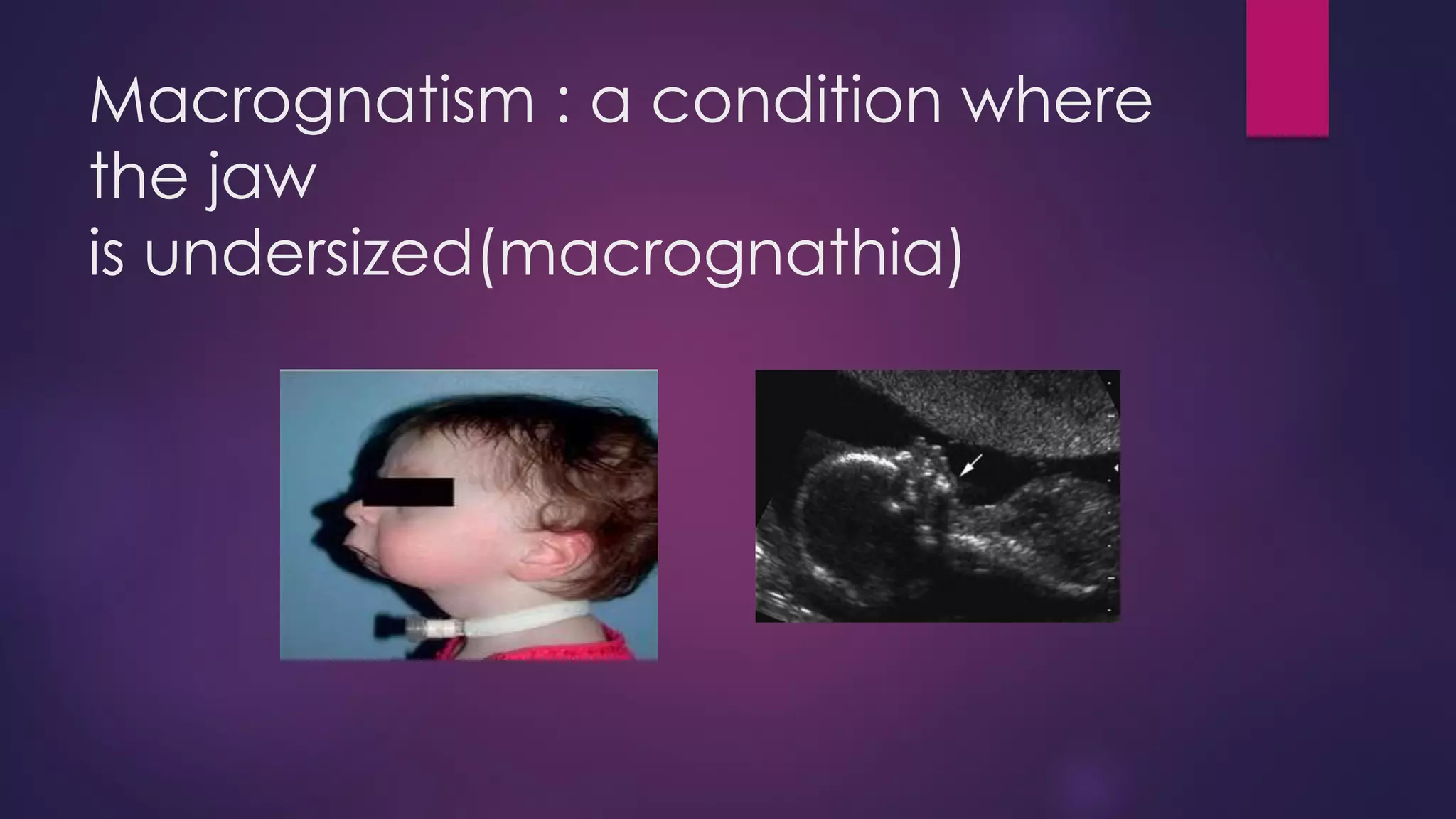 Trisomy 18 group 3 | PDF