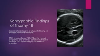 Trisomy 18 group 3 | PDF