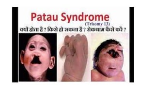 Trisomy 21 and other chromosomal abnormalities | PPTX