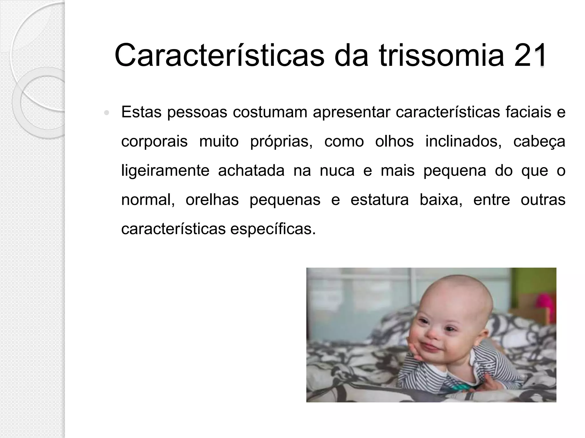 Trissomia 21 | PPT