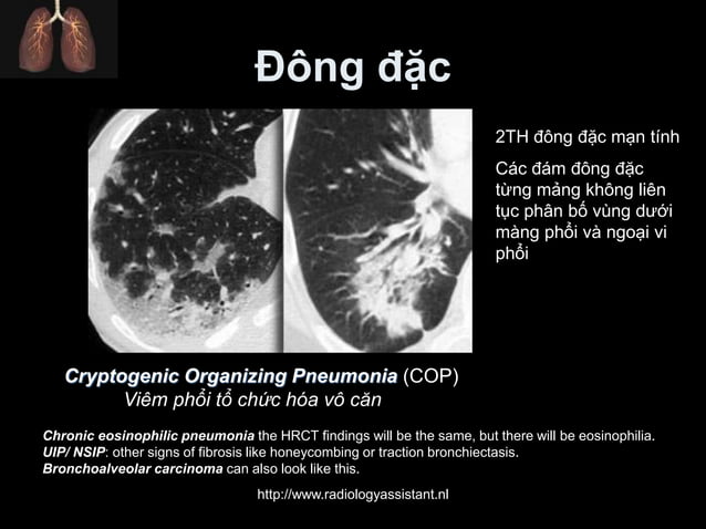 Triệu chứng trên chụp clvt phổi độ phân giải cao (hrct) | PPT