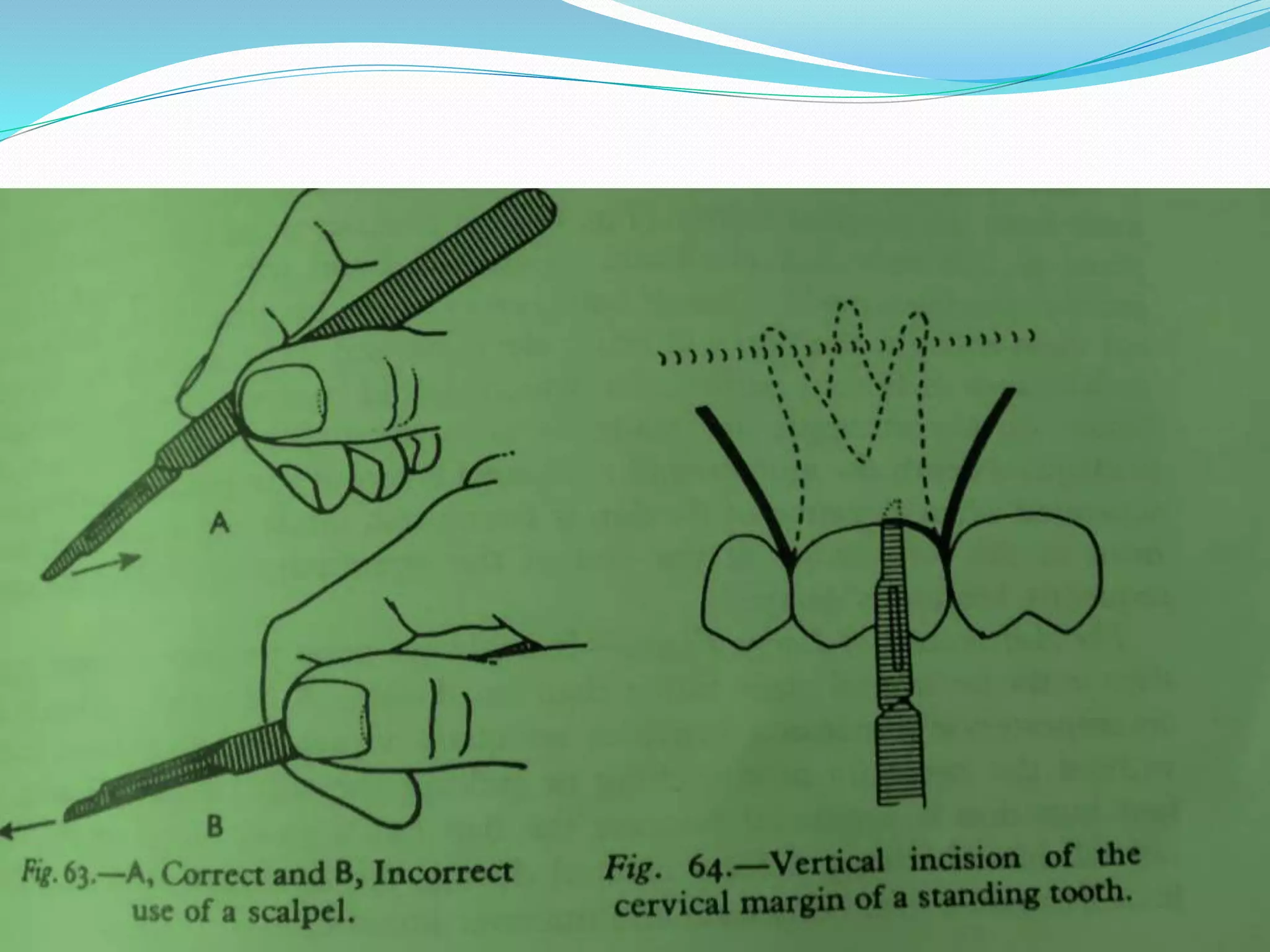 Trans Alveolar Extraction | PPTX