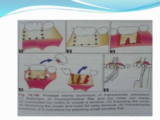 Trans Alveolar Extraction | PPT